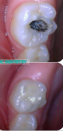 A non-invasive, painless treatment option for cavities! - Pollywog
